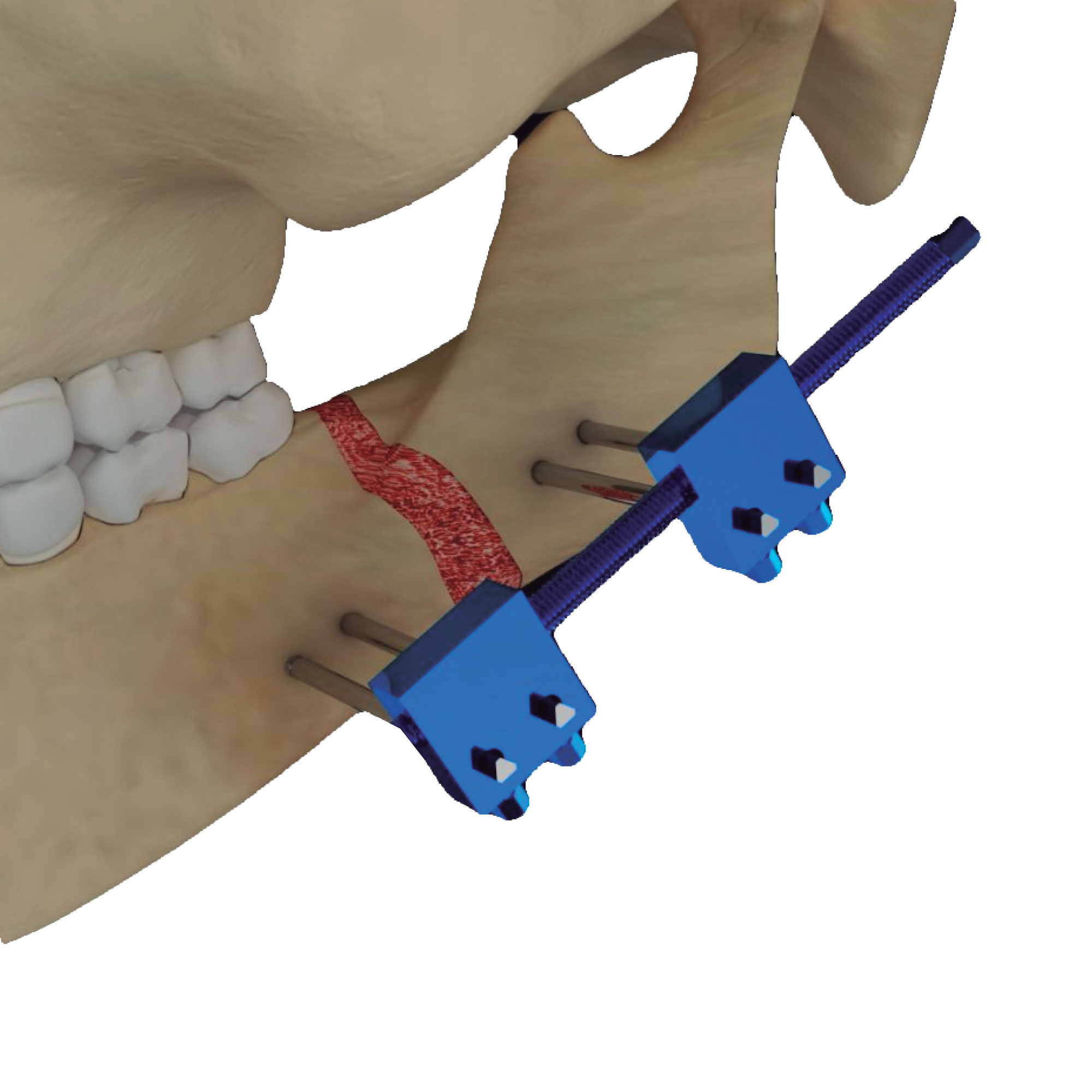 Distração osteogênica | Materialise